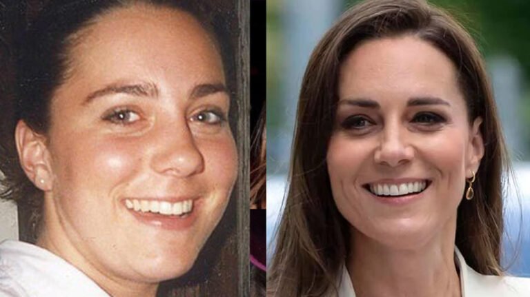 "Kate Middleton si è rifatta": le foto prima e dopo il ritocchino non ...